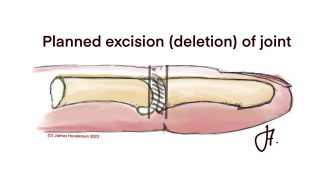 1.-Planned-excision-of-joint - James Henderson - Specialist Plastic ...