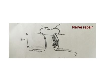 digital nerve repair - James Henderson - Specialist Plastic & Hand Surgeon