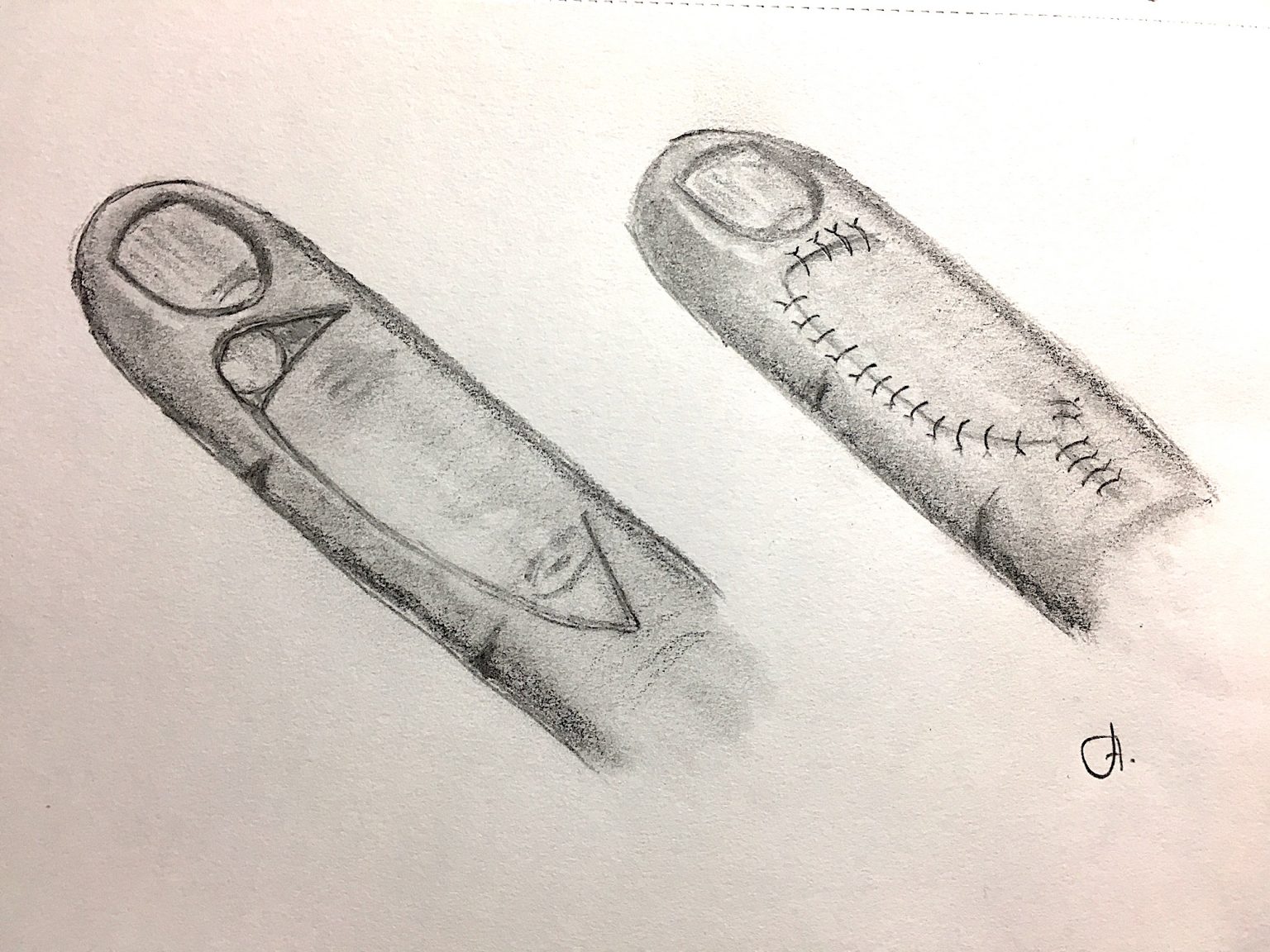 flap reconstruction after excision of mucous cyst from finger - James ...