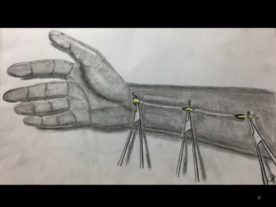 palmaris longus tendon harvest - James Henderson - Specialist Plastic ...