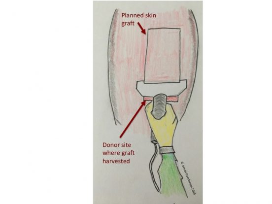 skin graft harvest - James Henderson - Specialist Plastic & Hand Surgeon