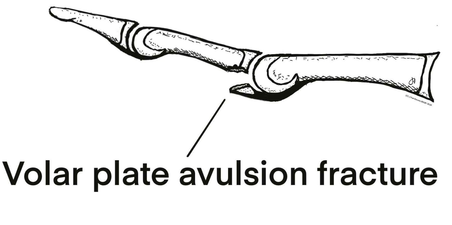 volar-plate-avulsion-fracture-web - James Henderson - Specialist ...